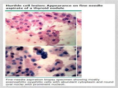 Approach To Thyroid Nodule Pptx Thyroid Disorders Endocrine And Metabolic Diseases