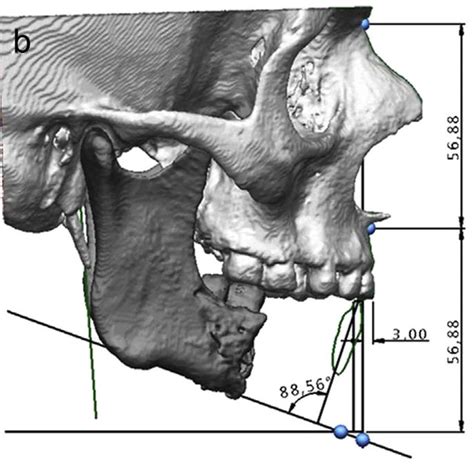 A Restoration Of The Correct Occlusion According To The Angle S