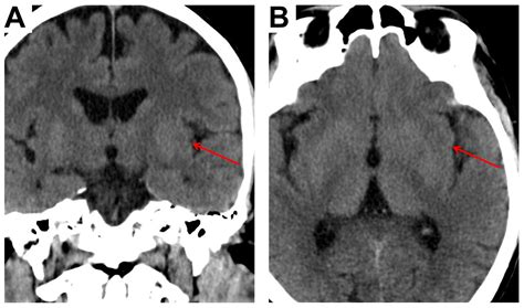 An Isolated Insular Stroke Mimics A Bout Of Overt Hepatic Encephalopathy In A Patient With
