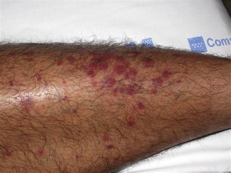 Cutaneous Vasculitis