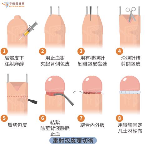 割包皮費用高嗎？認識包莖、包皮過長手術方式、包皮槍原理