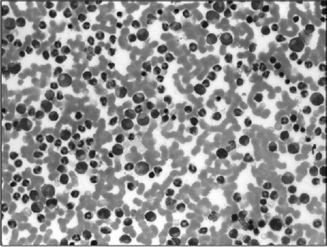 Bone Marrow Aspiration Smear Shows Hypercellularity And Increased Download Scientific Diagram