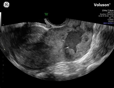 Cervicalcancer Cervicalcancerawarenessmonth Voluson Ultrasound