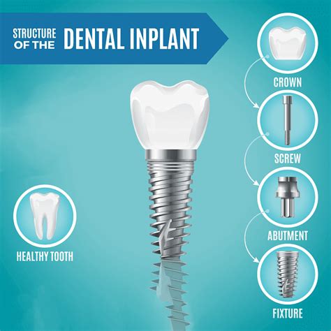 Fixture Component Of Implant At Susan Burke Blog