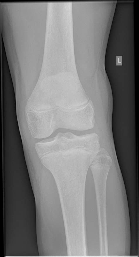 Tibial Tuberosity Avulsion Fracture Image