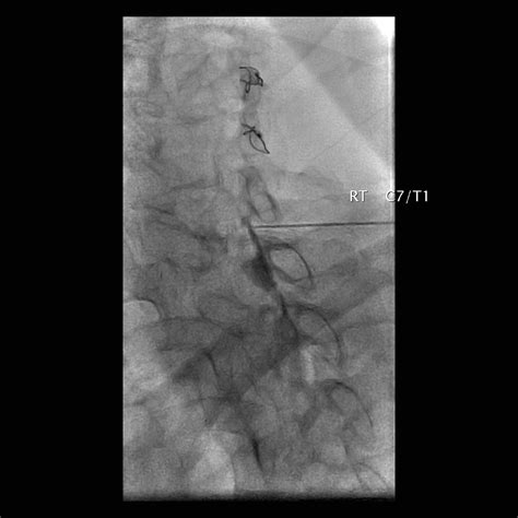 Cervical Interlaminar Epidural Steroid Injection Fluoroscopic Guided