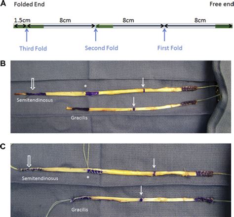 What Is A Hamstring Graft At Therese Arnold Blog