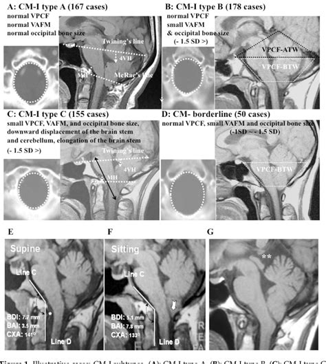 Figure 1 From Surgical Management Of Chiari Malformation Type I Associated With Syringomyelia
