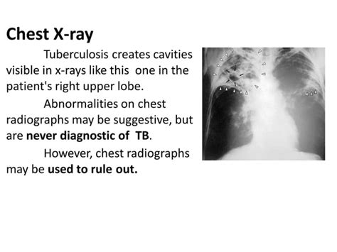 Tuberculosis Pdf Lung And Respiratory Health Diseases And Conditions