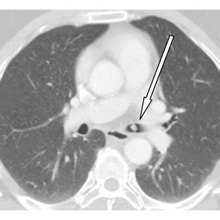 Axial CT Of Chest Lung Window At The Level Of Left Main Pulmonary