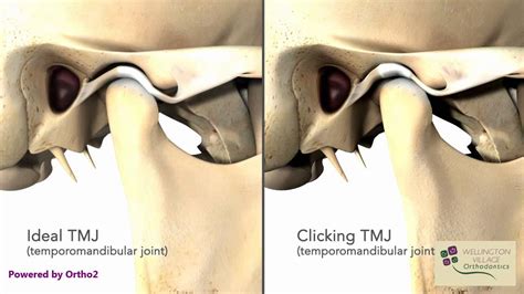 TMJ Clicking Wellington Village Orthodontics YouTube