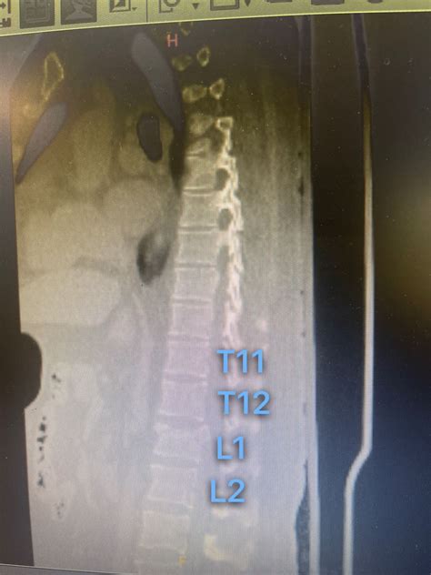 Dr Mirza Mudassir Baig On Linkedin Burst Fracture Are Common Spinal