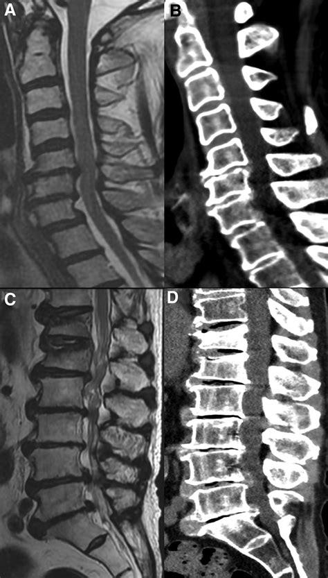 Campylobacter Fetus Induced Primary Psoas Abscess In Patient Medicine
