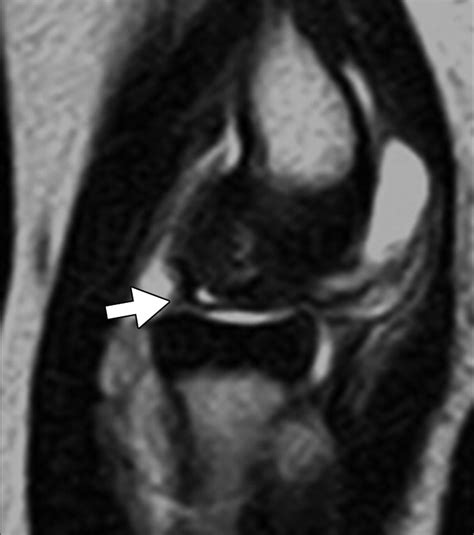 Mri Of The Annular Ligament Of The Elbow Review Of Anatomic