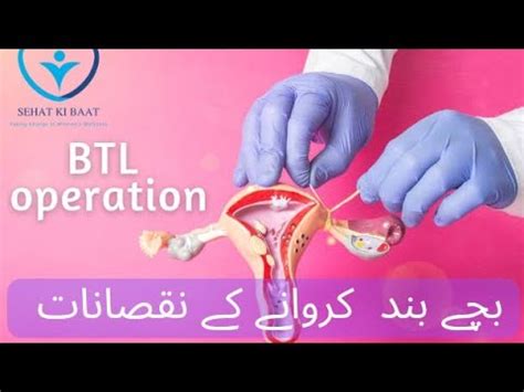BTL Surgery Bache Band Krwane Ka Operation Aur Iska Nuqsan YouTube