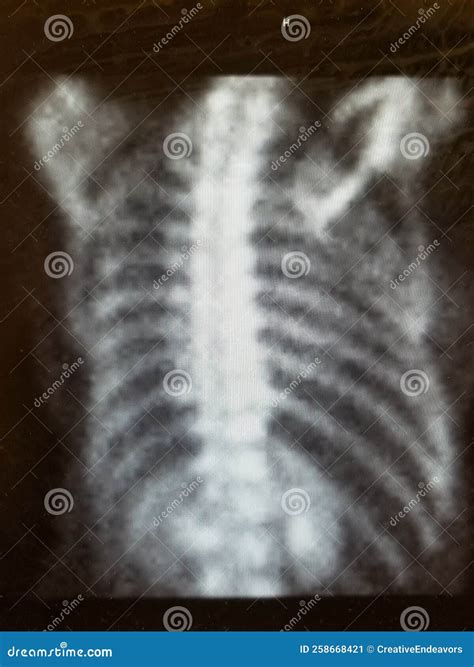 Indium Labeled Wbc Scan Normal Scan Images Stock Image Image Of