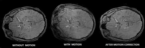 Robin Medical Inc Motion Artifact Correction