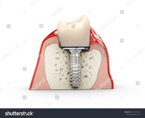 Human Teeth Dental Implant 3d Illustration Stock Illustration