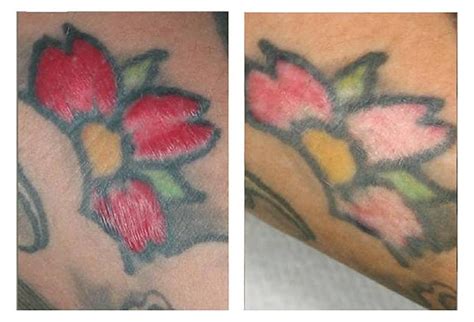 Allergic Reaction To Tattoo Treatment