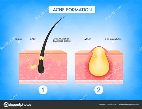 Formation Skin Acne Pimple Accumulation Dead Cells Sebum Clogged Pore