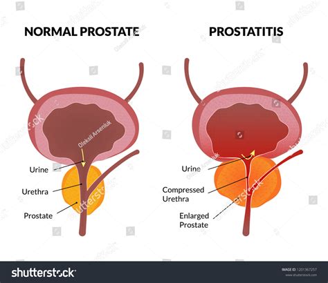 Prostatitis Pathology Poster Stock Illustration 1201367257 Shutterstock
