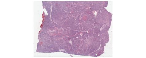 Ovarian Cancer Object Detection Dataset By Data6000 Capstone