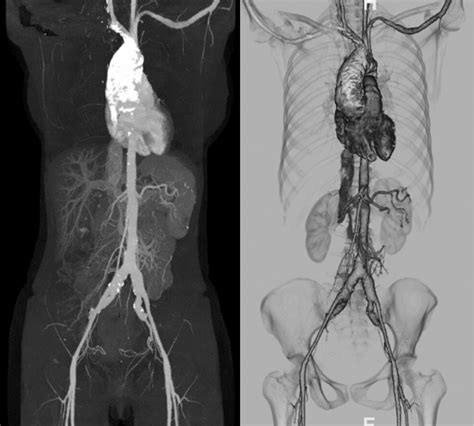 An Adult Fatal Case With A Stat1 Gain Of Function Mutation Associated