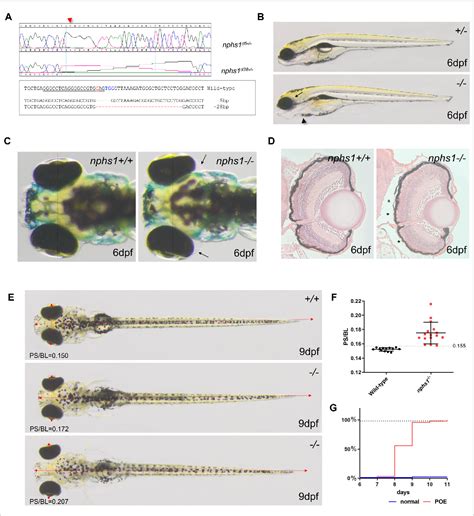 Figure 1 From A Zebrafish Model Of Congenital Nephrotic Syndrome Of The