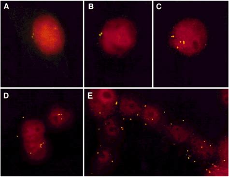 Centrosome Amplification And Instability Occurs Exclusively In Aneuploid But Not In Diploid