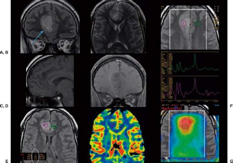 Adult Brain Tumors Radiology Key