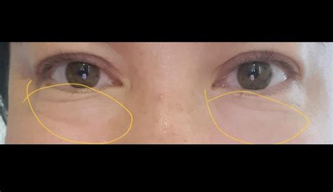 Im 37 And Got A Lower Bleph 10 Days Ago Heres My Experience R