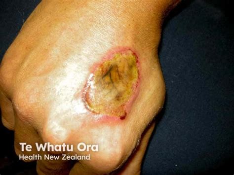 Pyoderma Gangrenosum Image