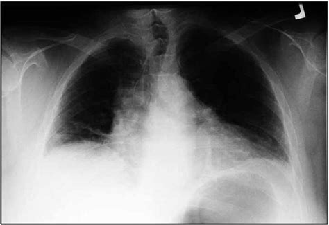 Oboustranná Léze N Phrenicus Manifestující Se Jako Ortopnoe