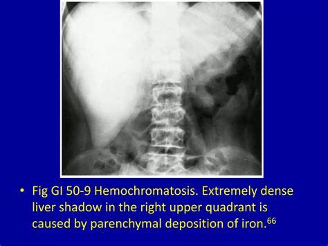 50 Liver Calcification Pptx