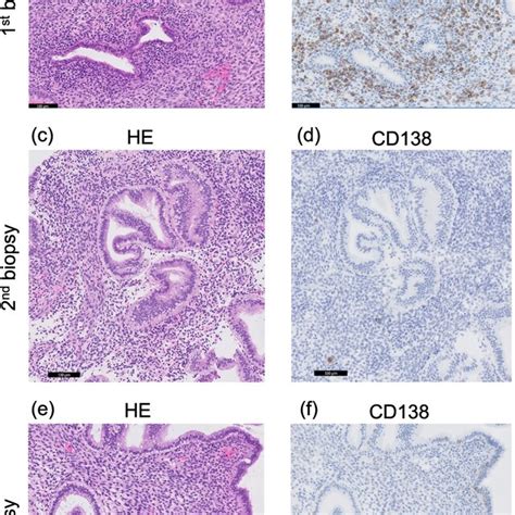 Diagnosis Of Chronic Endometritis Based On Histopathology Findings Of