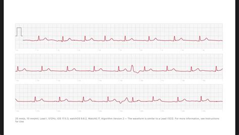 Anyone Have Multifocal Pvcs R Pvcs
