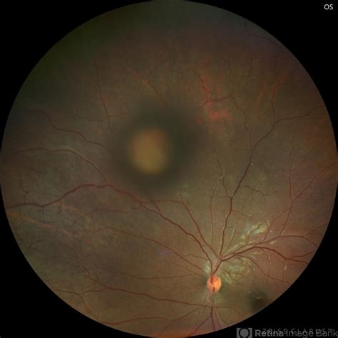 Salmon Patch Retina Image Bank