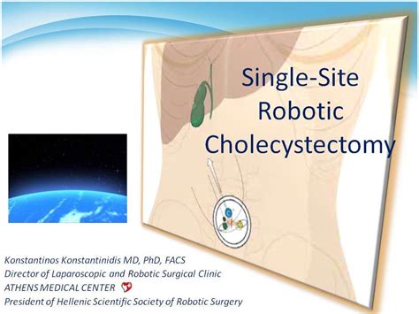 Ρομποτική Χολοκυστεκτομή μιας οπής Single Site Robotic Cholecystectomy