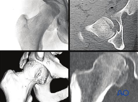 Femoral Head Fractures With Posterior Wall Fracture Of The Acetabulum