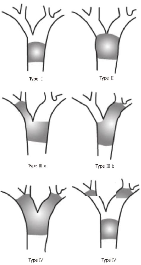 Klatskin Tumor Stages Of