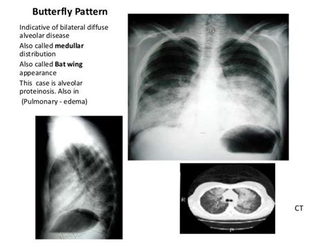 Chest X Ray