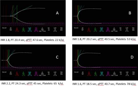 Teg During Defibrotide Therapy With Corresponding Abnormal Rct A At Download Scientific