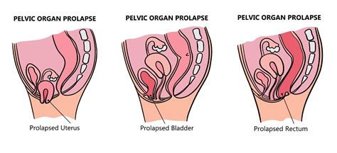 Pelvic Organ Prolapse Patient Care