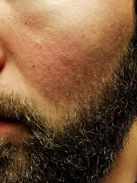 Ipl Vs Ktp Vs Pdl For Persistent Redness Rosacea Type 1 R Rosacea