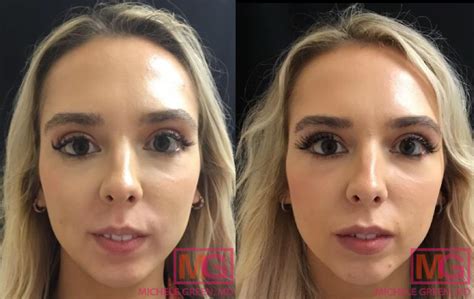 Lip Flip Vs Lip Fillers Compare Lip Procedures Dr Michele Green Md