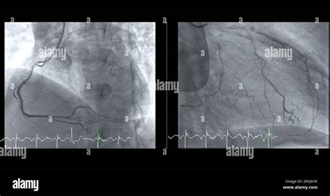Cardiac Catheterization On Rca And Lad Can Help Doctor Diagnose And