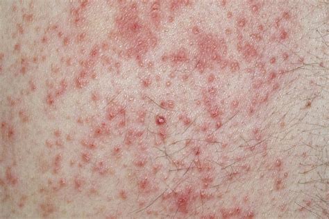 Eczema Symptoms And Diagnosis Hse Ie