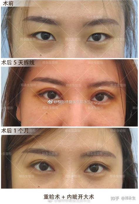 双眼皮术后疤痕增生的原因 知乎