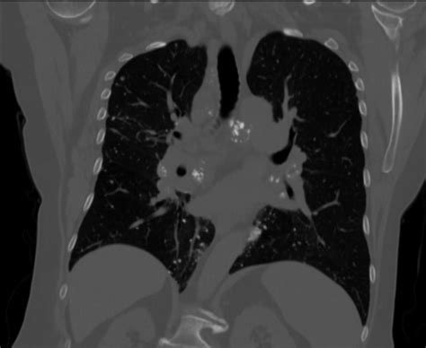 Amyloid Lymph Nodes The Common Vein
