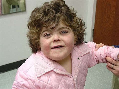 Cornelia De Lange Syndrome Photos Xaxo
